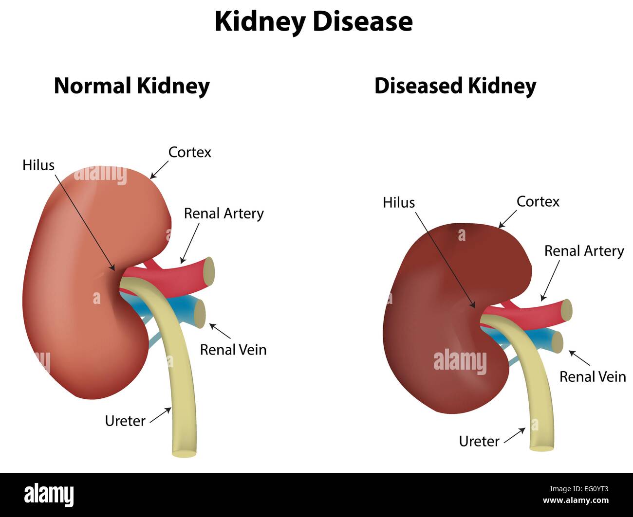 Kidney Failure Stock Photos & Kidney Failure Stock Images - Alamy