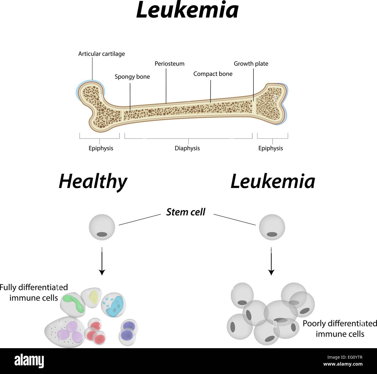 Leukemia cancer hi-res stock photography and images - Alamy