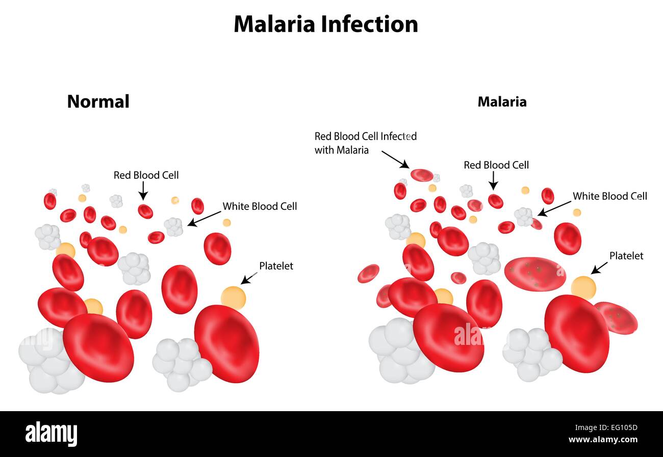 Malaria illustration Stock Vector Images - Alamy