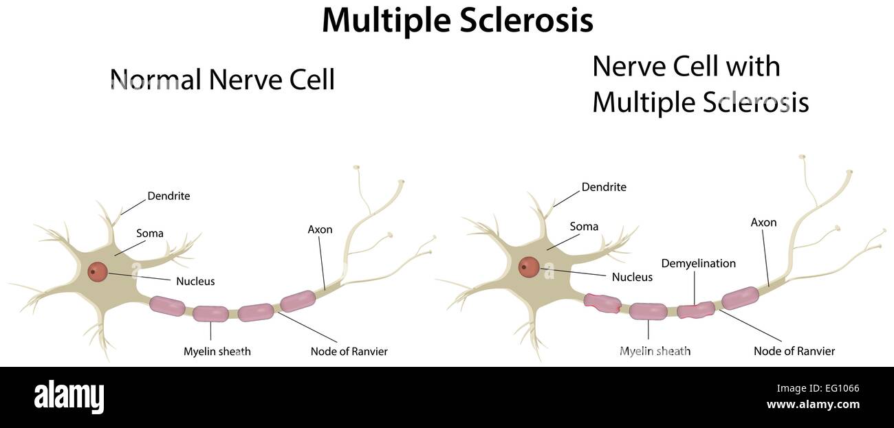 Demyelination hi-res stock photography and images - Alamy