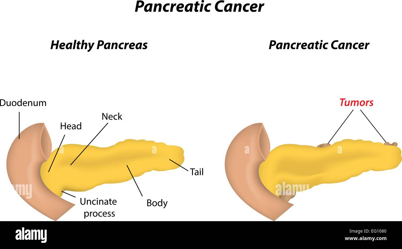 Pancreatic cancer hi-res stock photography and images - Alamy