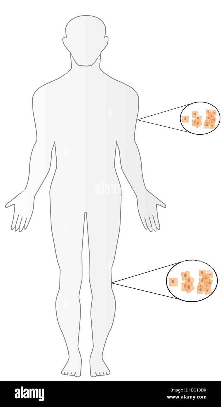 Skin cancer melanoma Stock Vector Images - Alamy