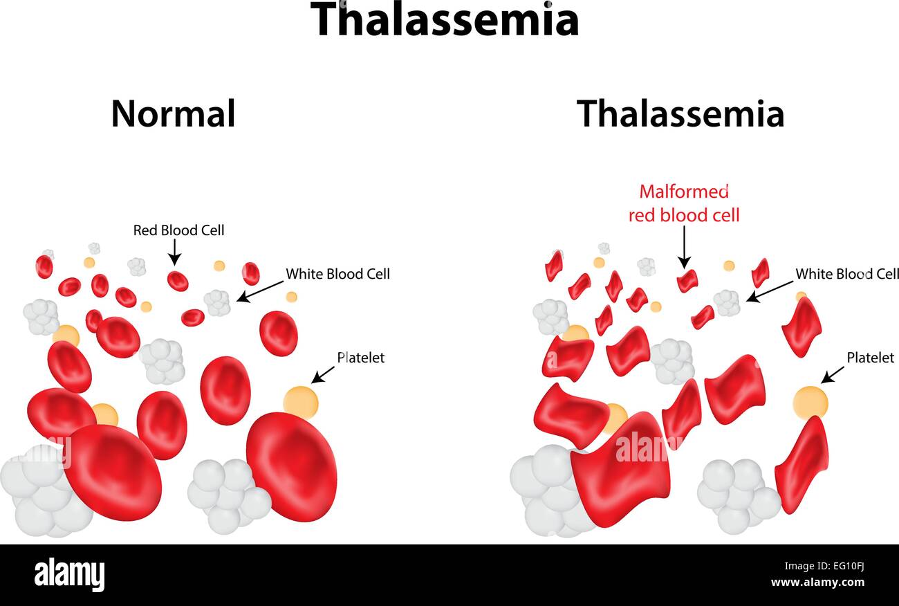 Thalassemia Blood Disorder