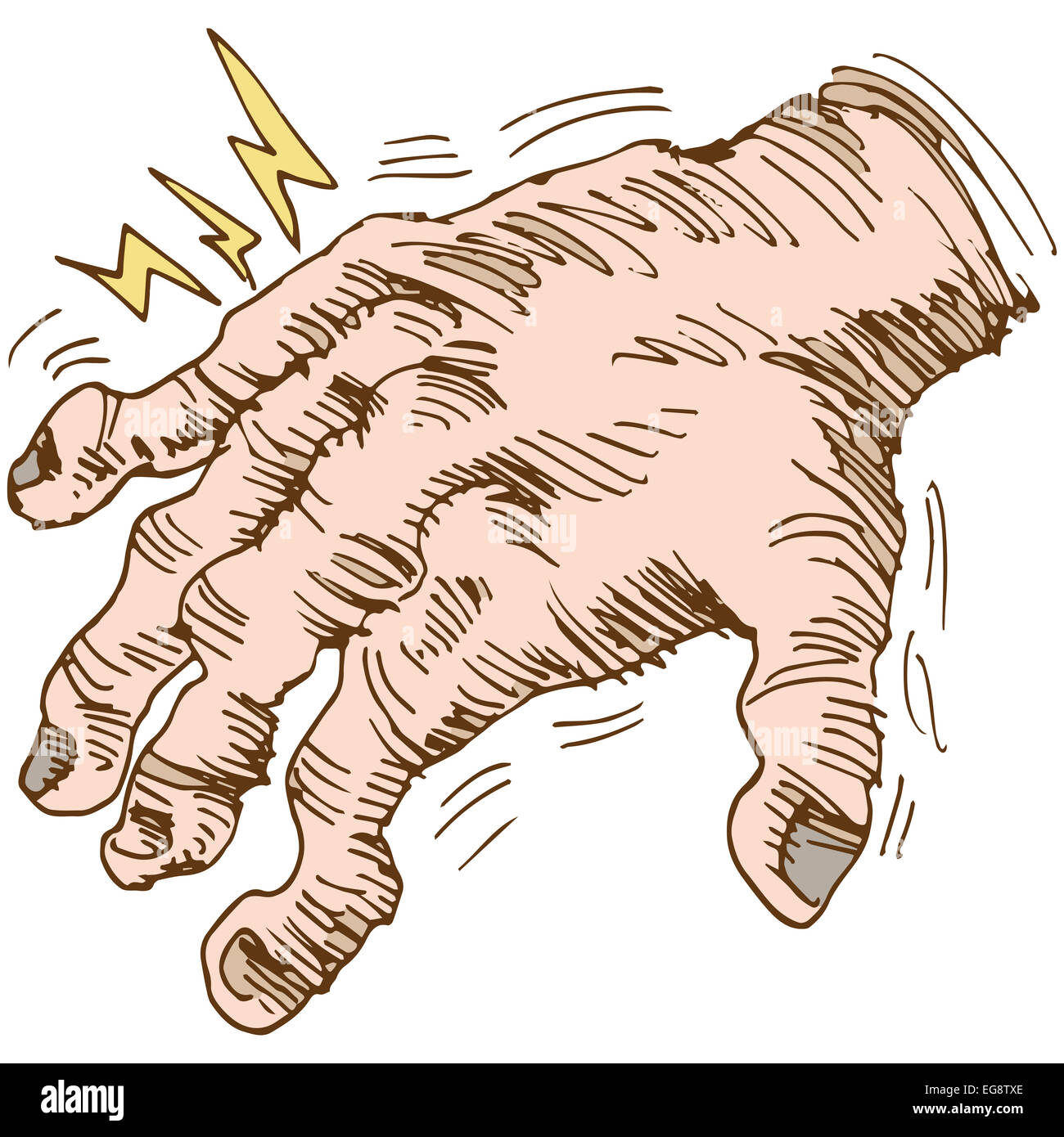 An image of a disfigured arthritis hand Stock Photo - Alamy