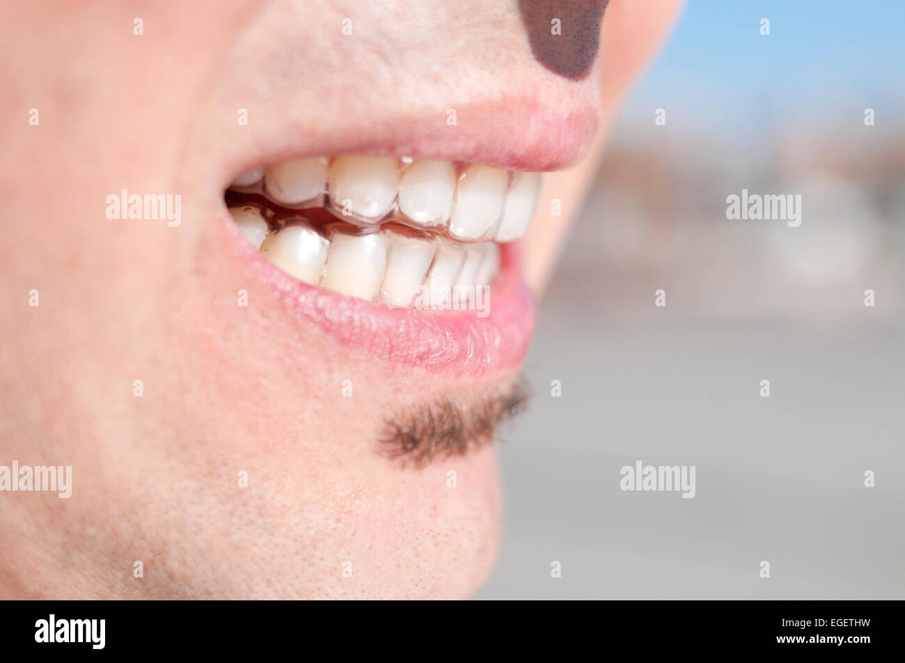 closeup of the mouth of a young man who is wearing clear retainers ...