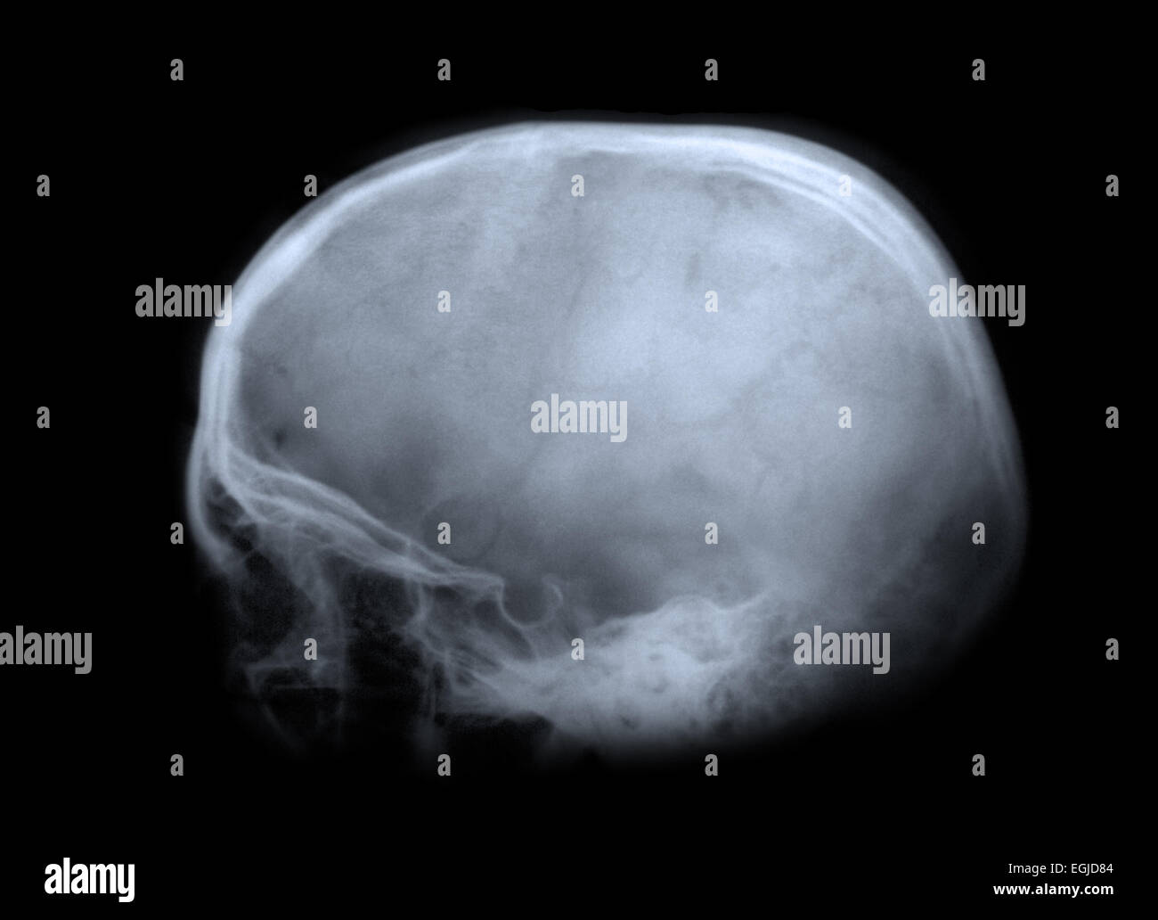 X ray of human skull hi-res stock photography and images - Alamy