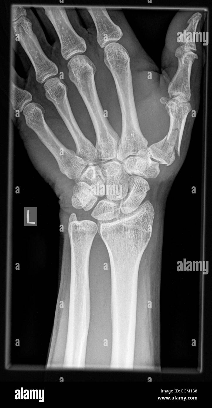 Metacarpal hi-res stock photography and images - Alamy