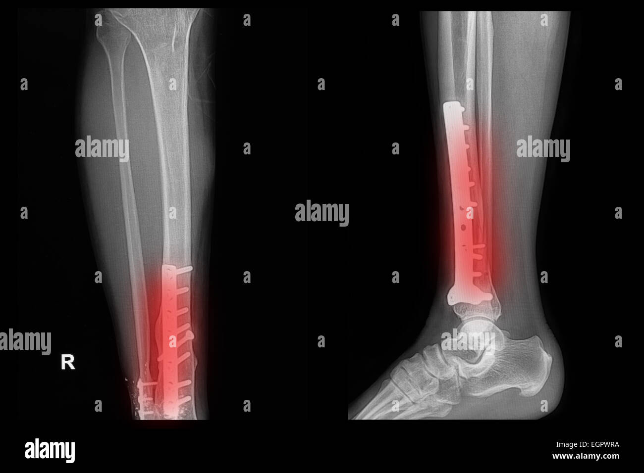 Fracture of tibia and fibula hi-res stock photography and images - Alamy