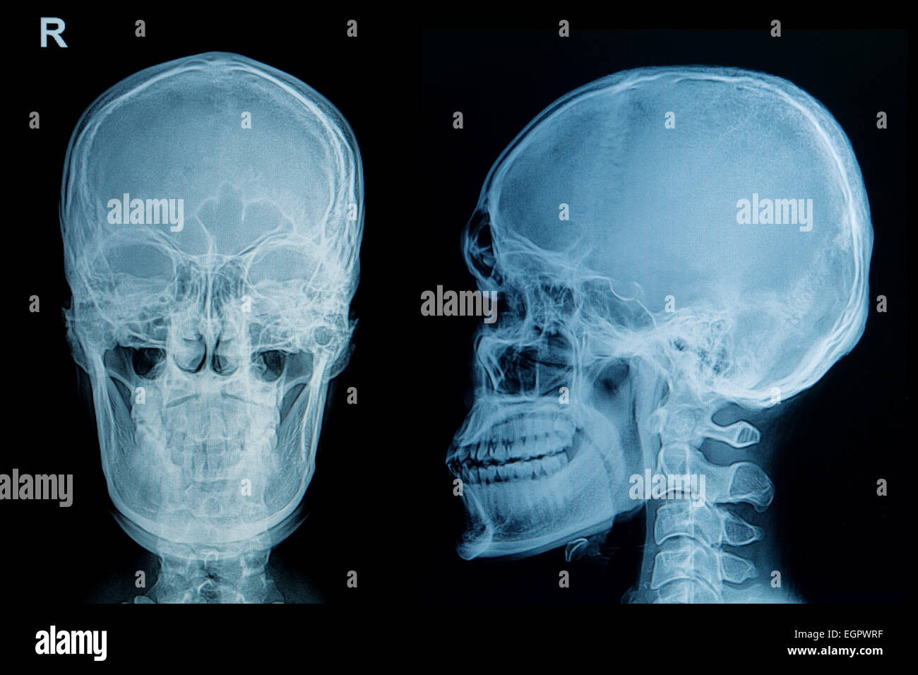 X ray skull cervical spine hi-res stock photography and images - Alamy