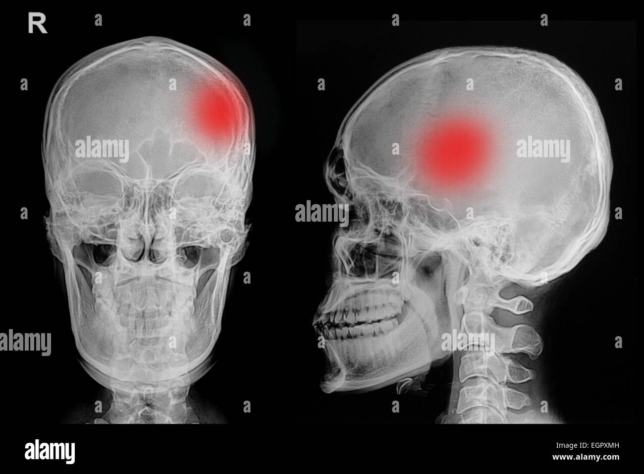 X-ray picture of the skull injury Stock Photo - Alamy