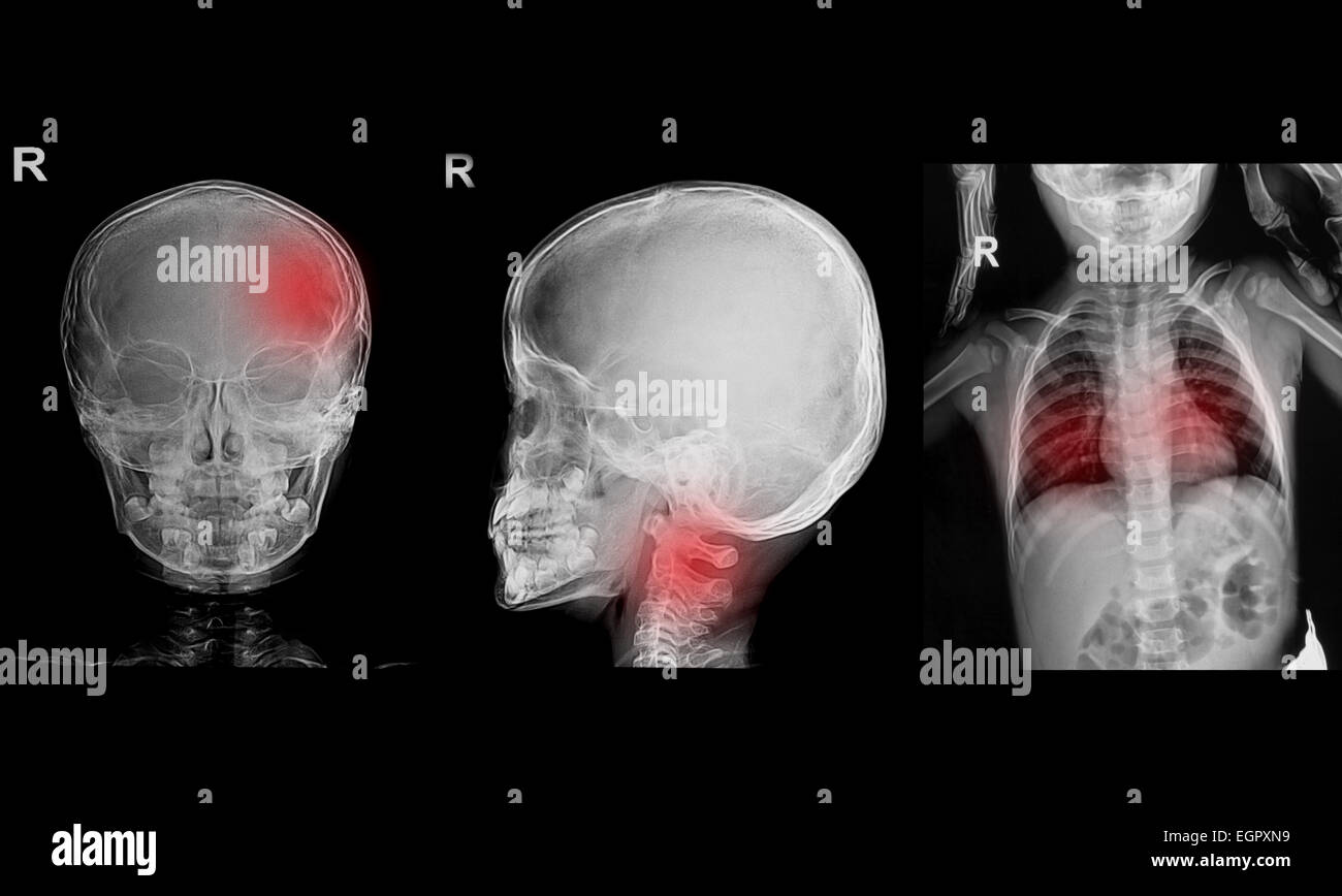 Collection of children x-rays image show skull and chest image Stock ...