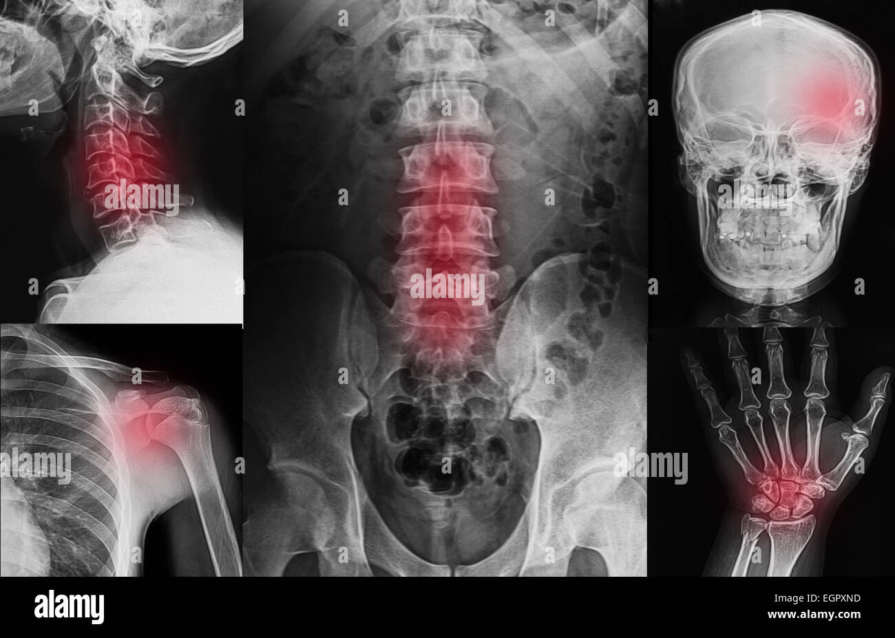 Collection x-rays image of human ,show upper extremity body part of ...