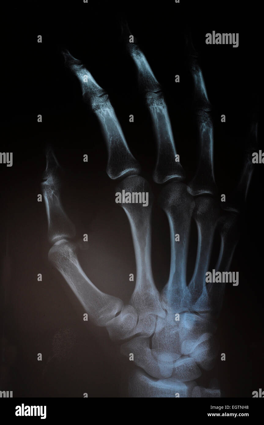Xray Orthopedic Medical Cat Scan Of Painful Hand Fingers Thumb Stock