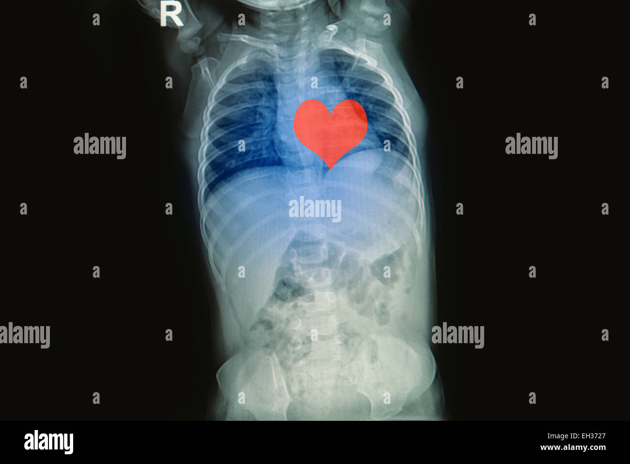 Chest x ray children hi-res stock photography and images - Alamy