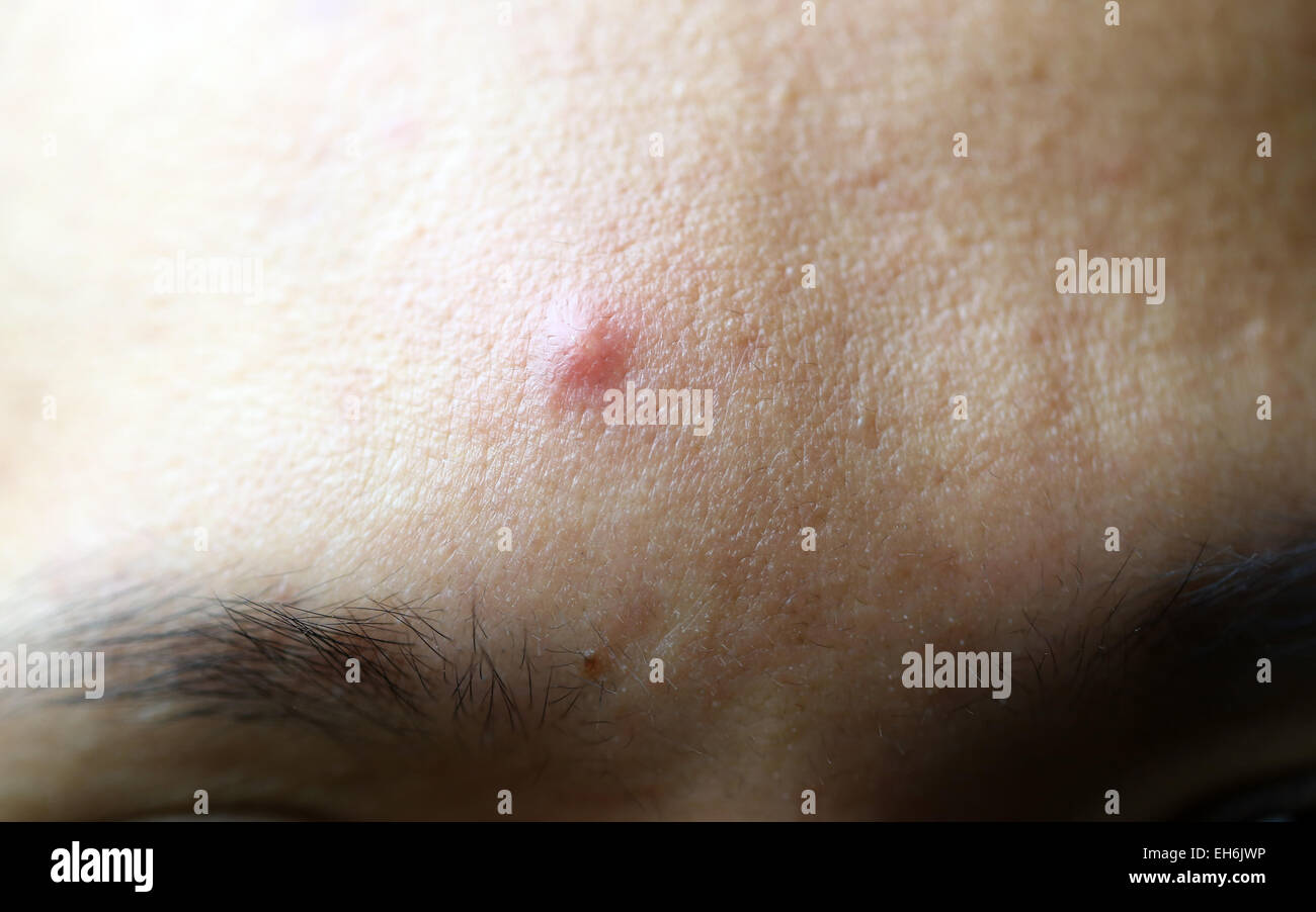 Acne face hi-res stock photography and images - Alamy