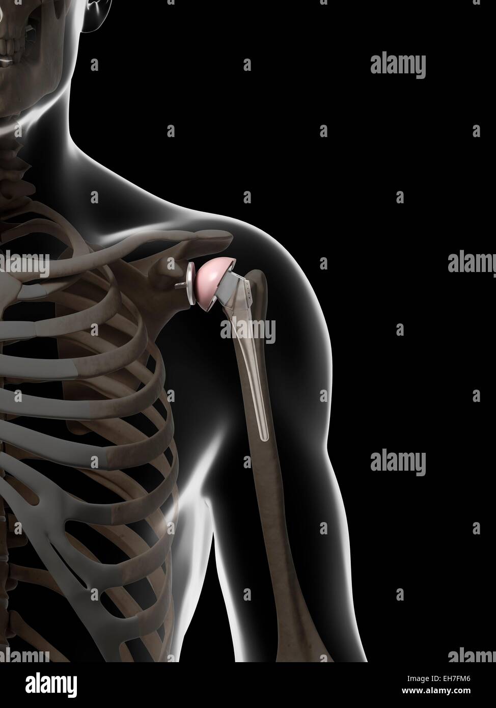Human shoulder replacement, artwork Stock Photo - Alamy