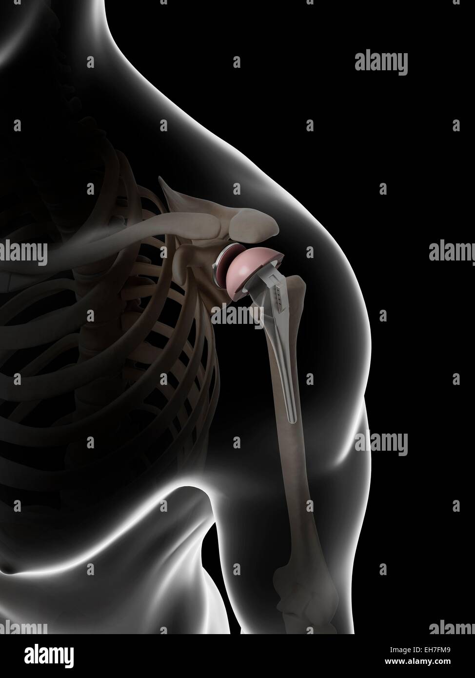 Human shoulder replacement, artwork Stock Photo - Alamy