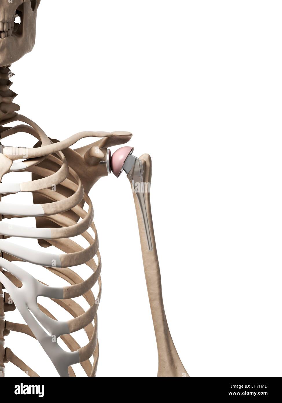Arthroplasty shoulder hi-res stock photography and images - Alamy