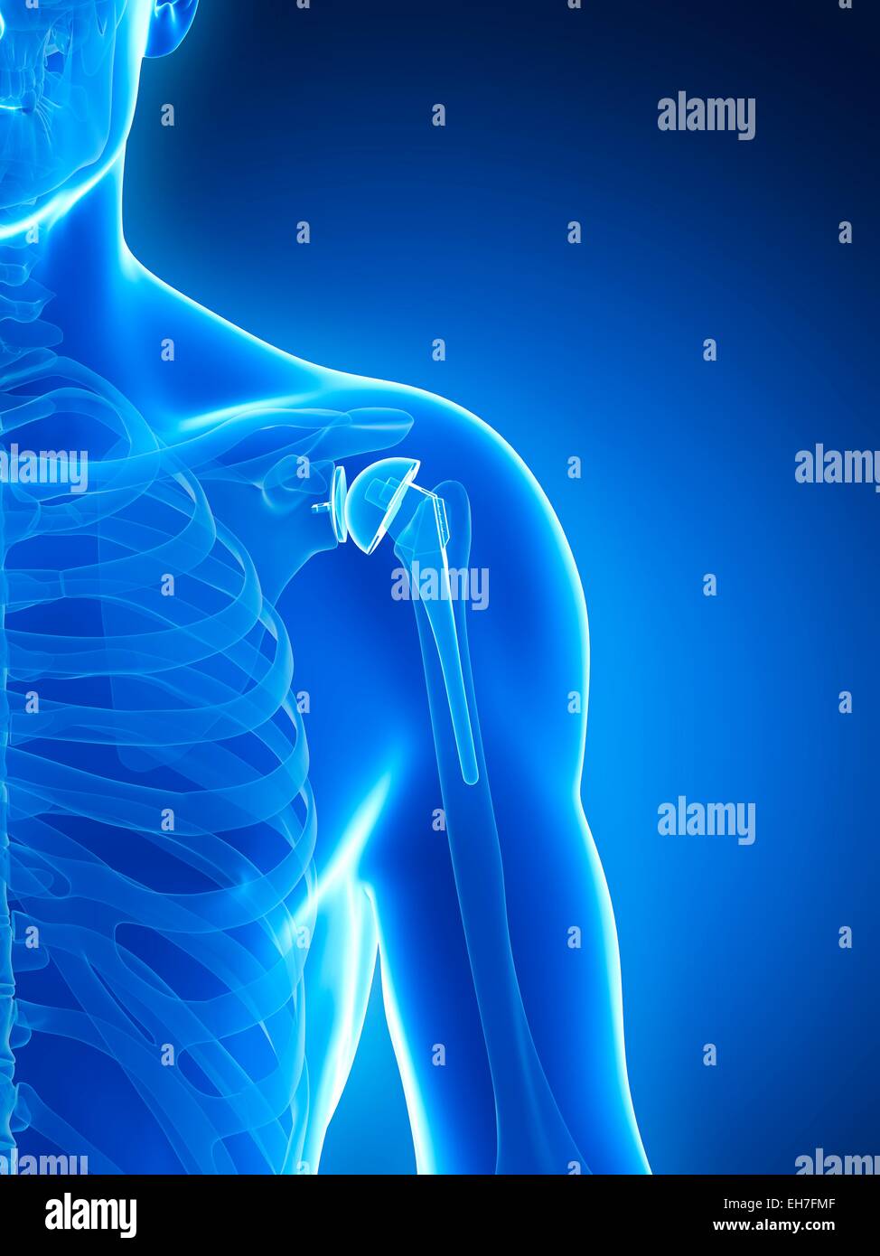 Shoulder joint replacement hi-res stock photography and images - Alamy