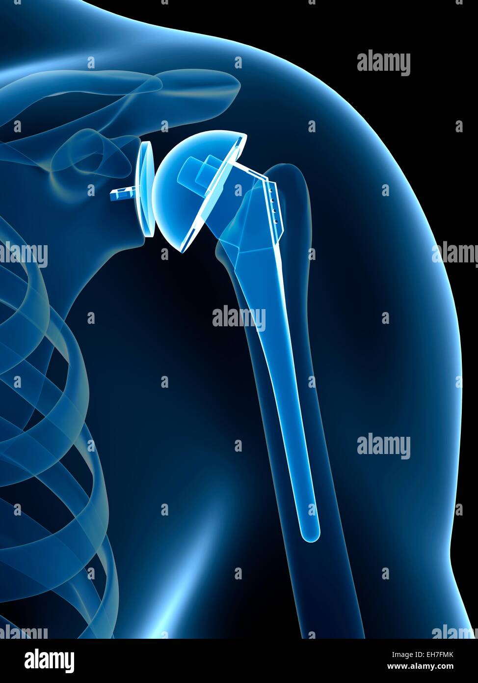 Human shoulder replacement, artwork Stock Photo - Alamy