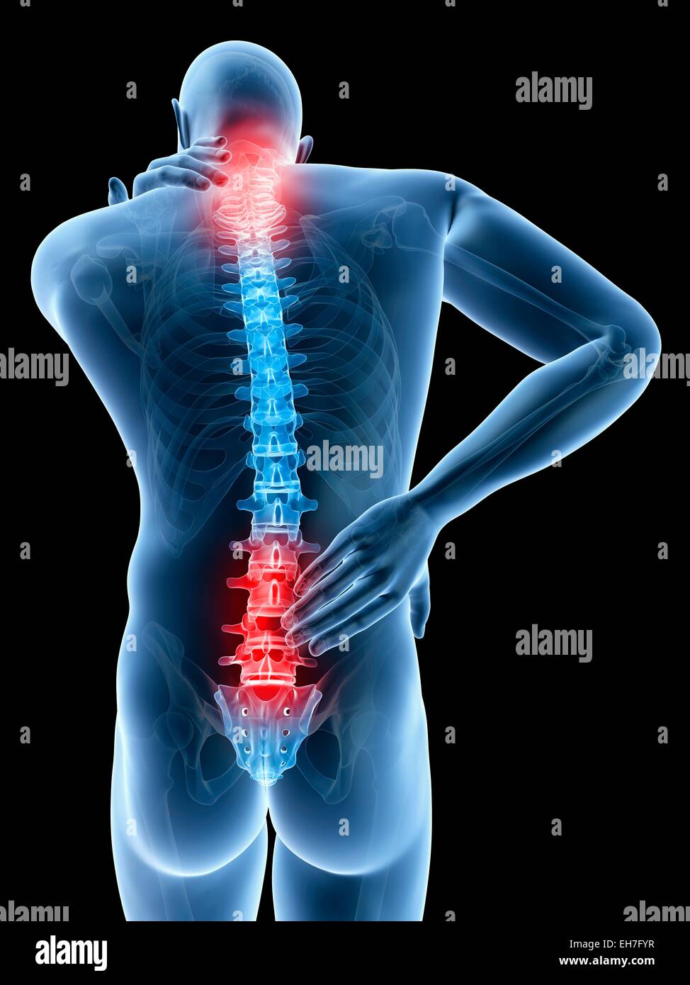 Human back pain, artwork Stock Photo - Alamy