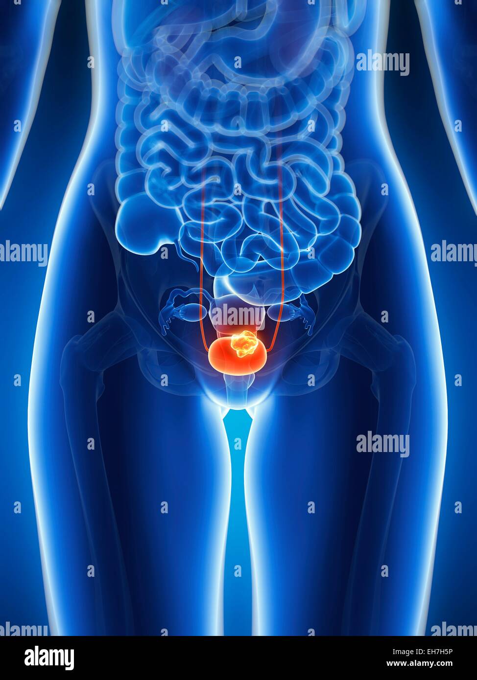 Human bladder cancer urinary hi-res stock photography and images - Alamy
