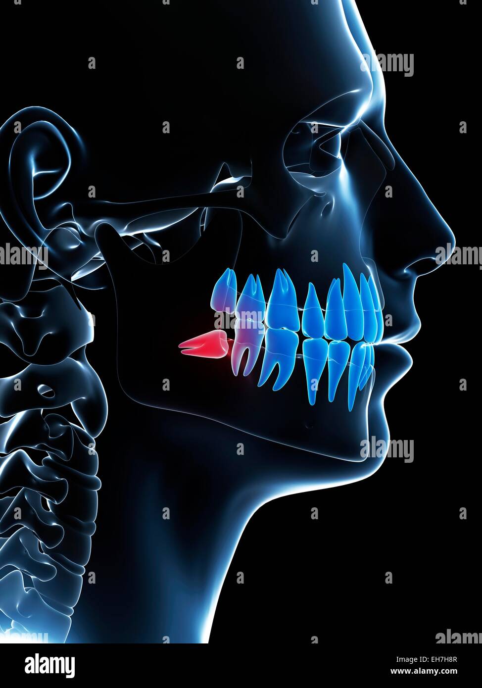 Impacted wisdom tooth, illustration Stock Photo - Alamy