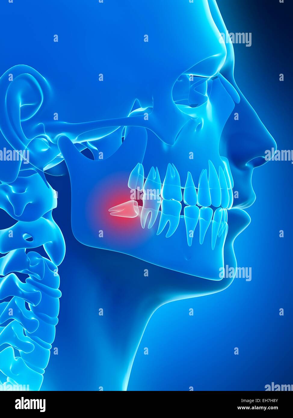 Wisdom tooth hi-res stock photography and images - Alamy