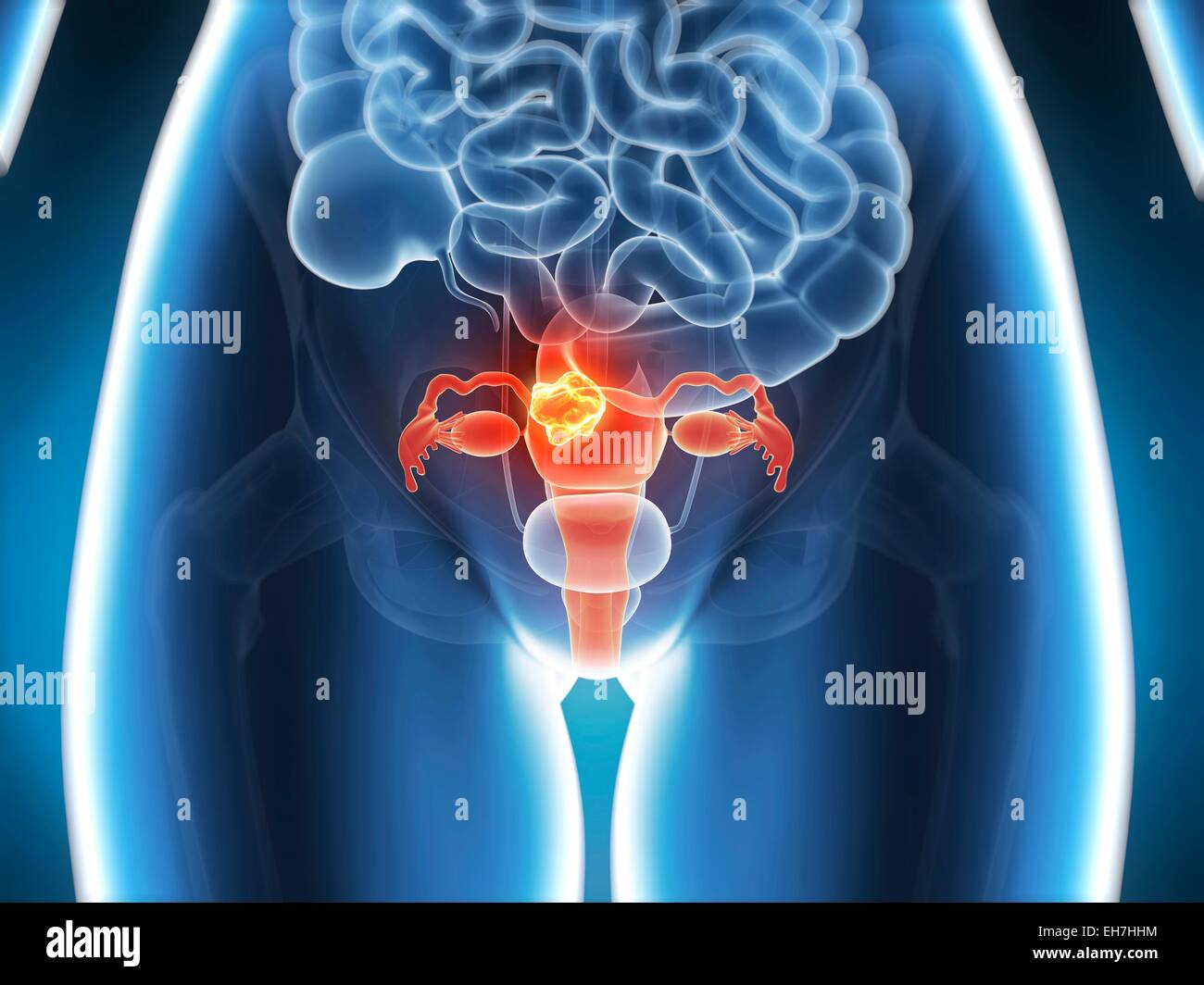 Cancer of the uterus, illustration Stock Photo - Alamy