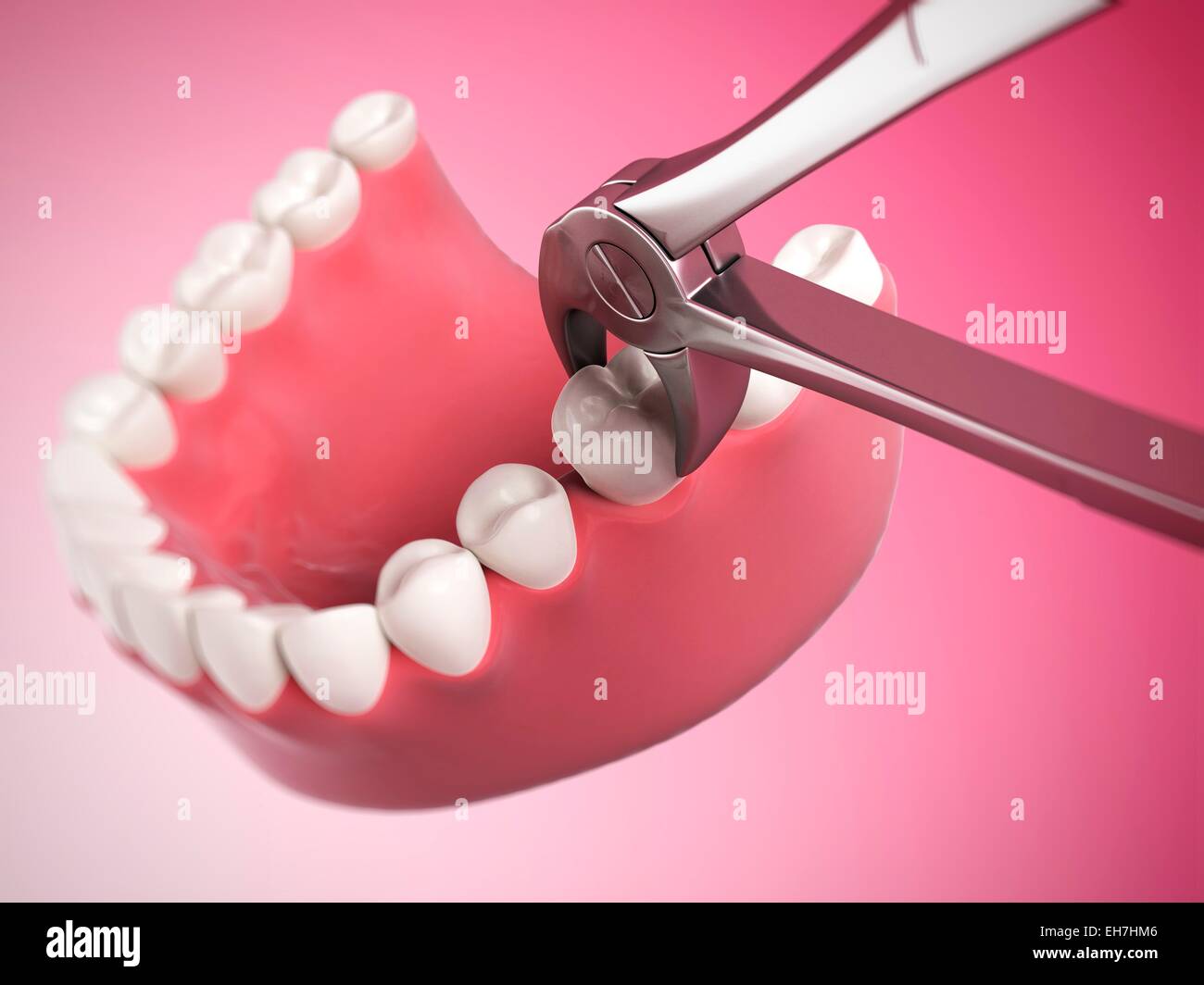 Human tooth being removed hi-res stock photography and images - Alamy