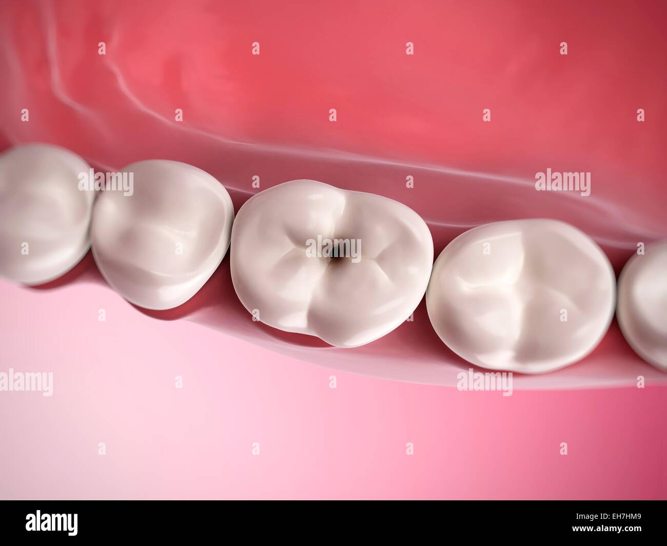 Human tooth decay, illustration Stock Photo - Alamy
