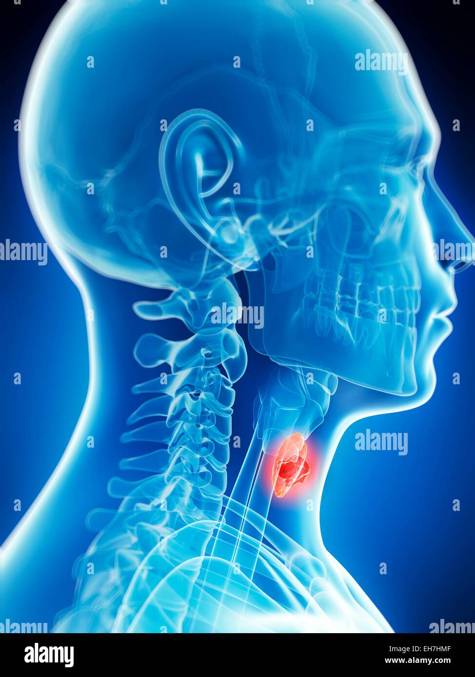 Human thyroid cancer hi-res stock photography and images - Alamy
