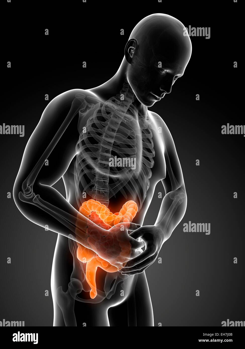 Abnormal Large Intestine High Resolution Stock Photography and Images ...