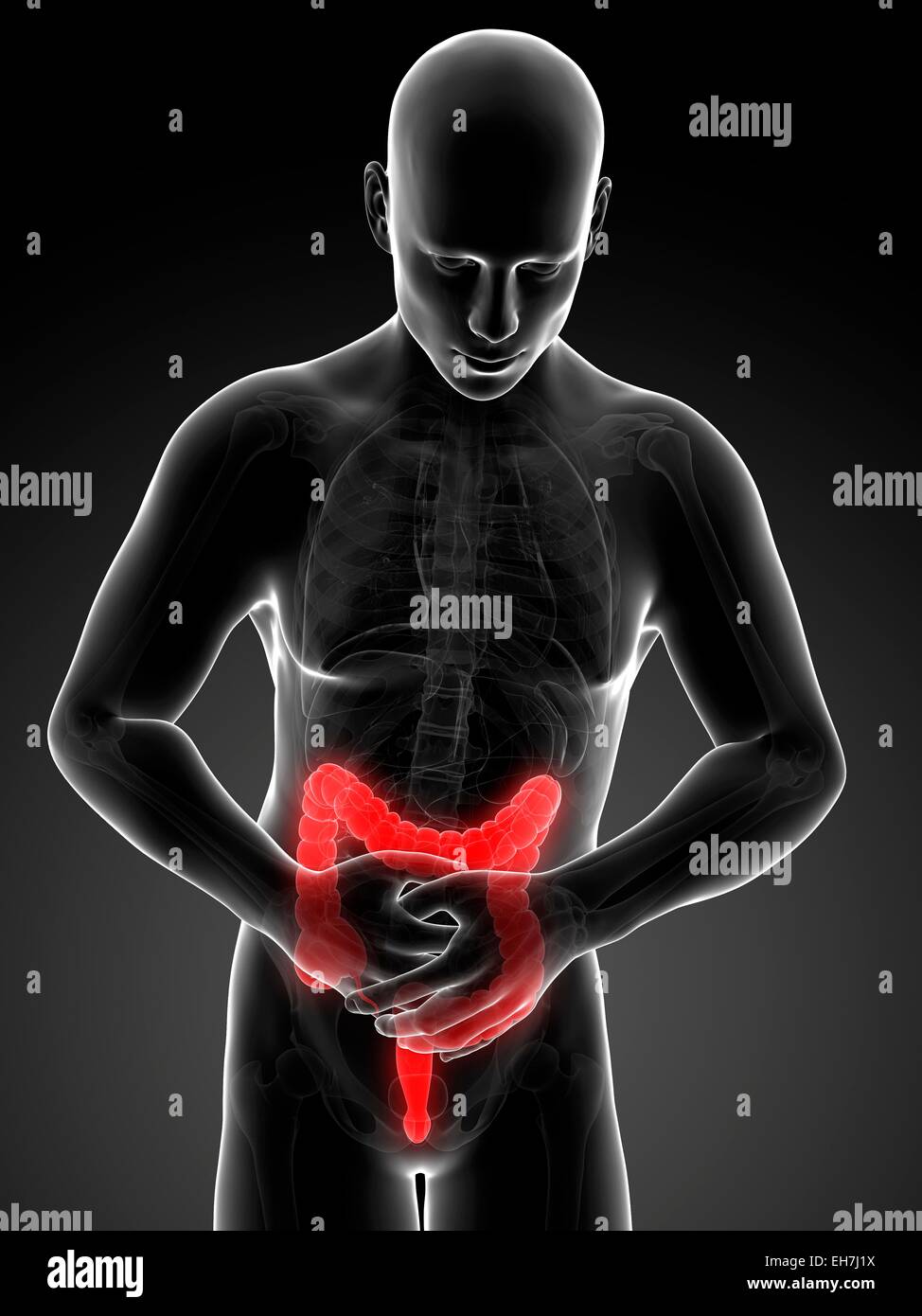 Abnormal large intestine hi-res stock photography and images - Alamy