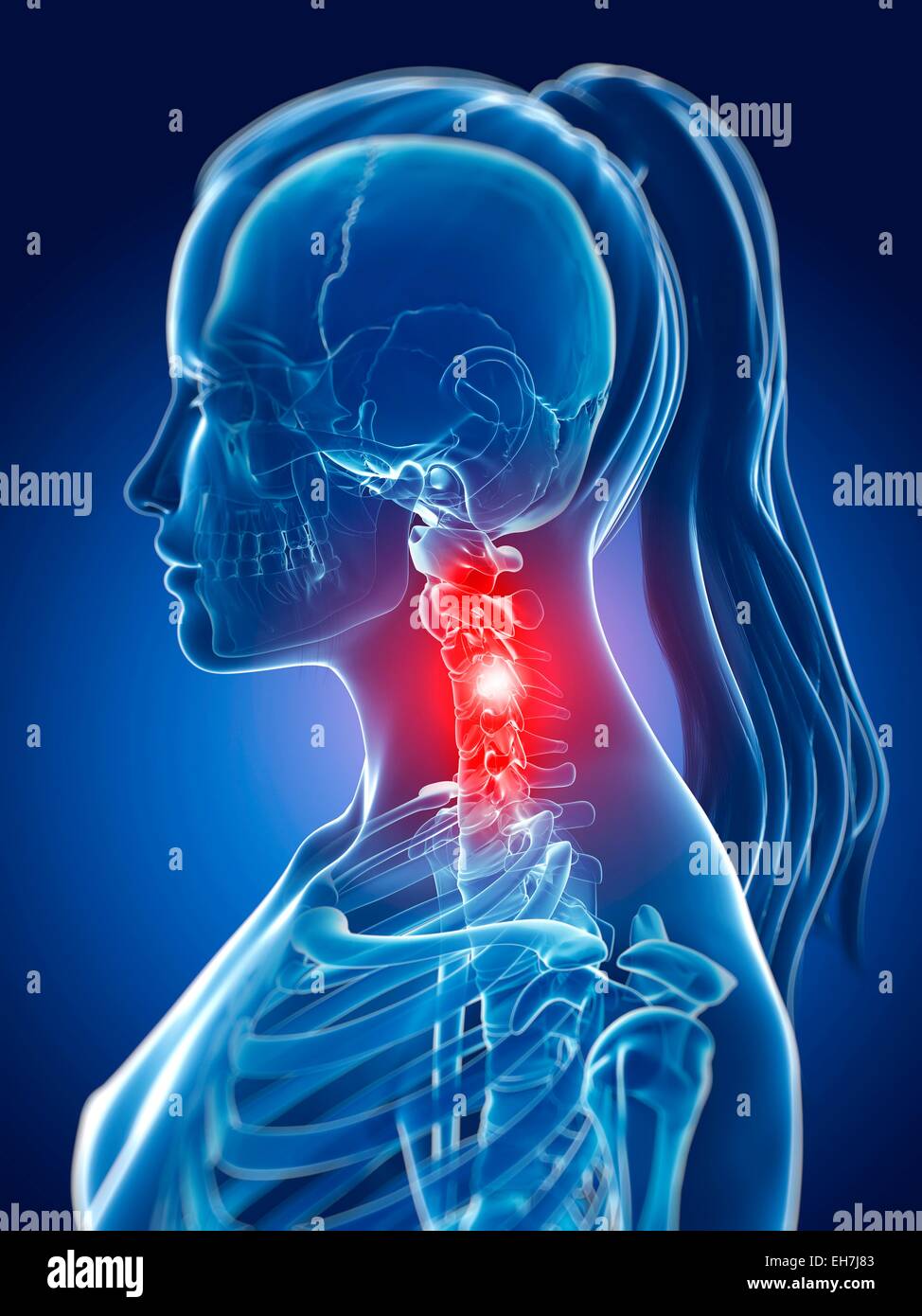 Human neck pain, illustration Stock Photo - Alamy