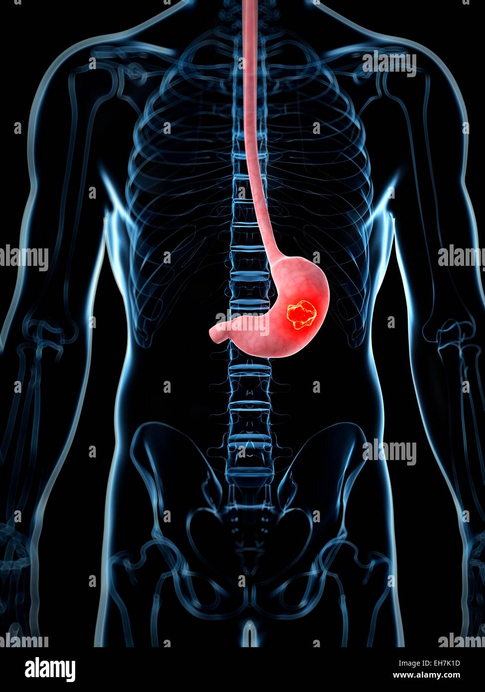 Human stomach cancer, illustration Stock Photo - Alamy