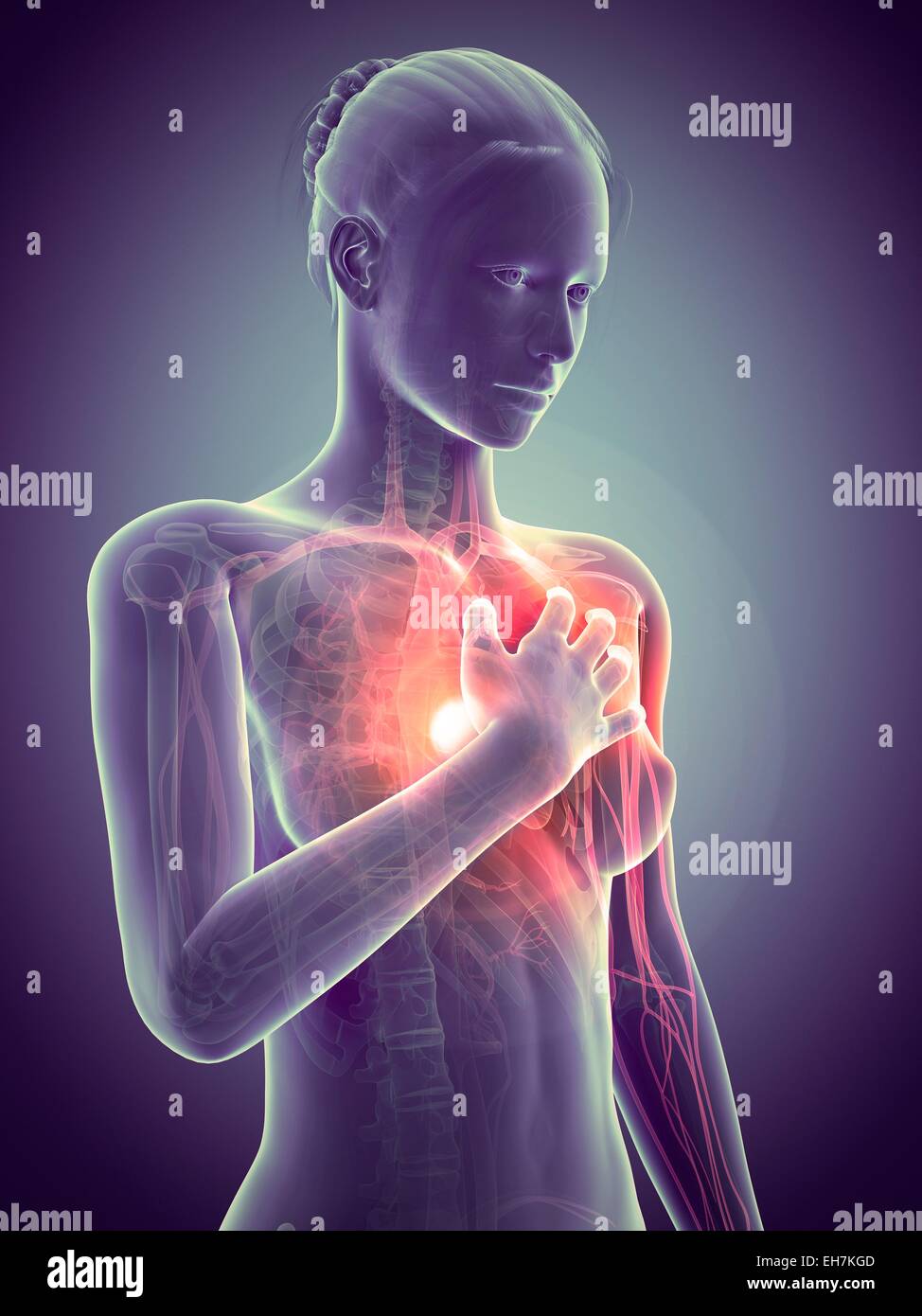 Human heart attack, illustration Stock Photo - Alamy