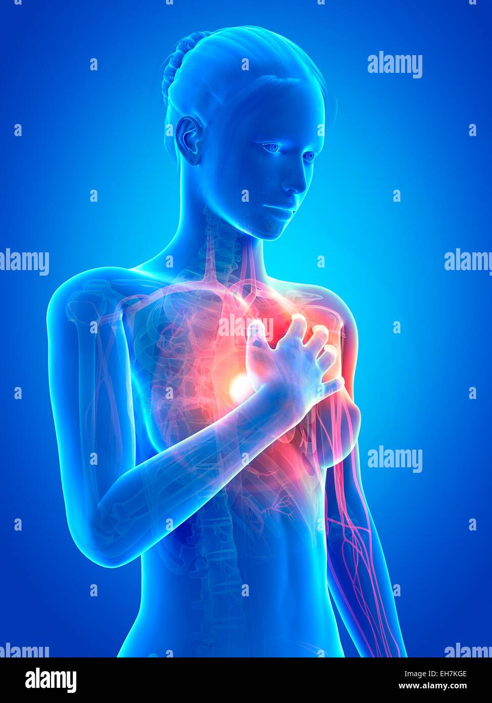Human heart attack hi-res stock photography and images - Alamy