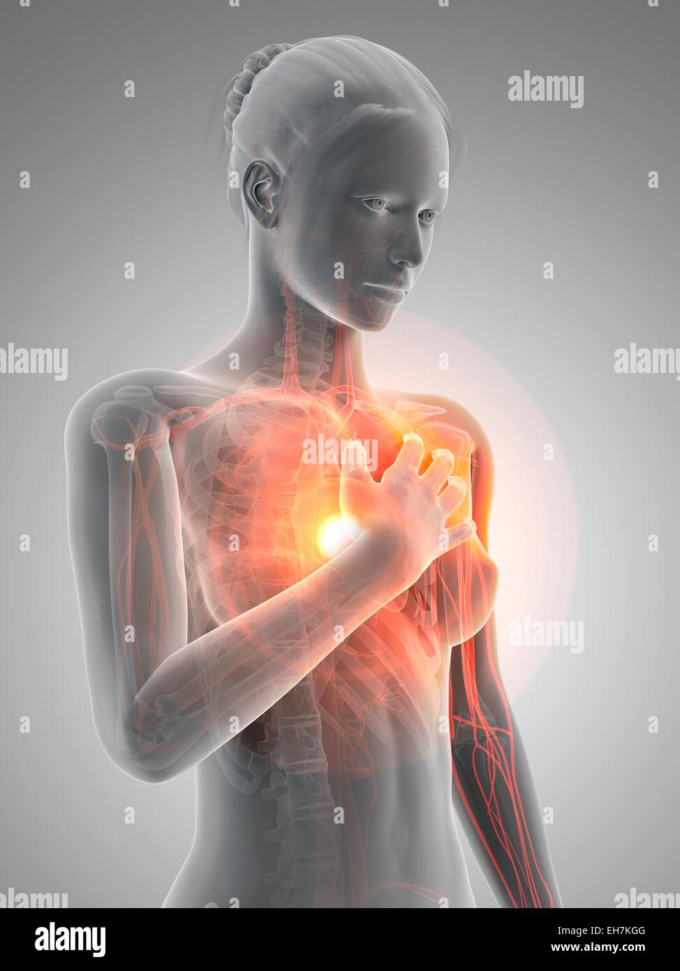 Human heart attack, illustration Stock Photo - Alamy