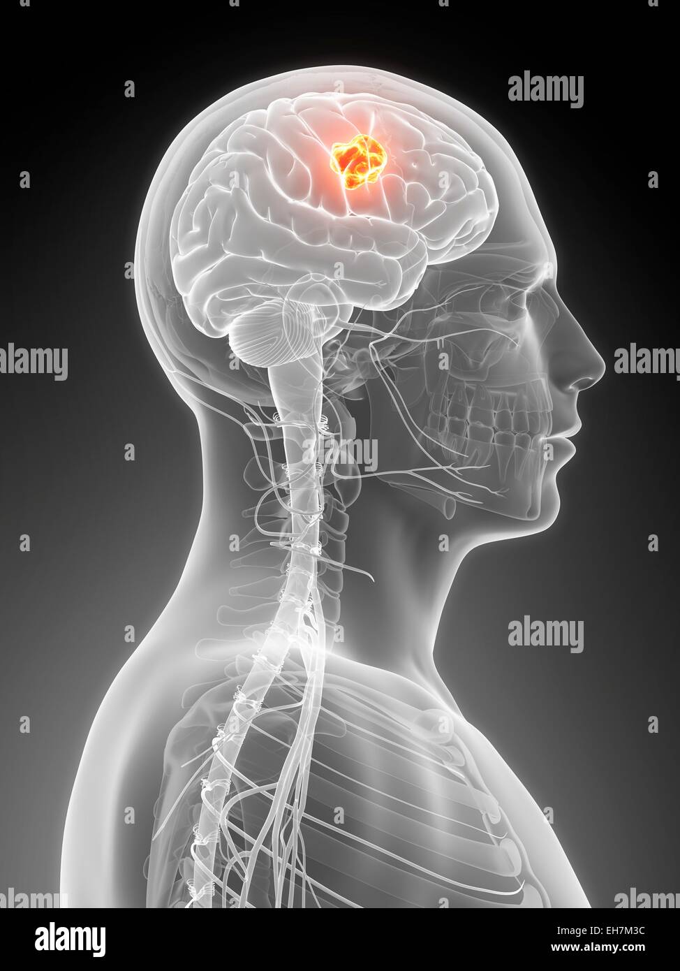 Human brain tumor, illustration Stock Photo - Alamy