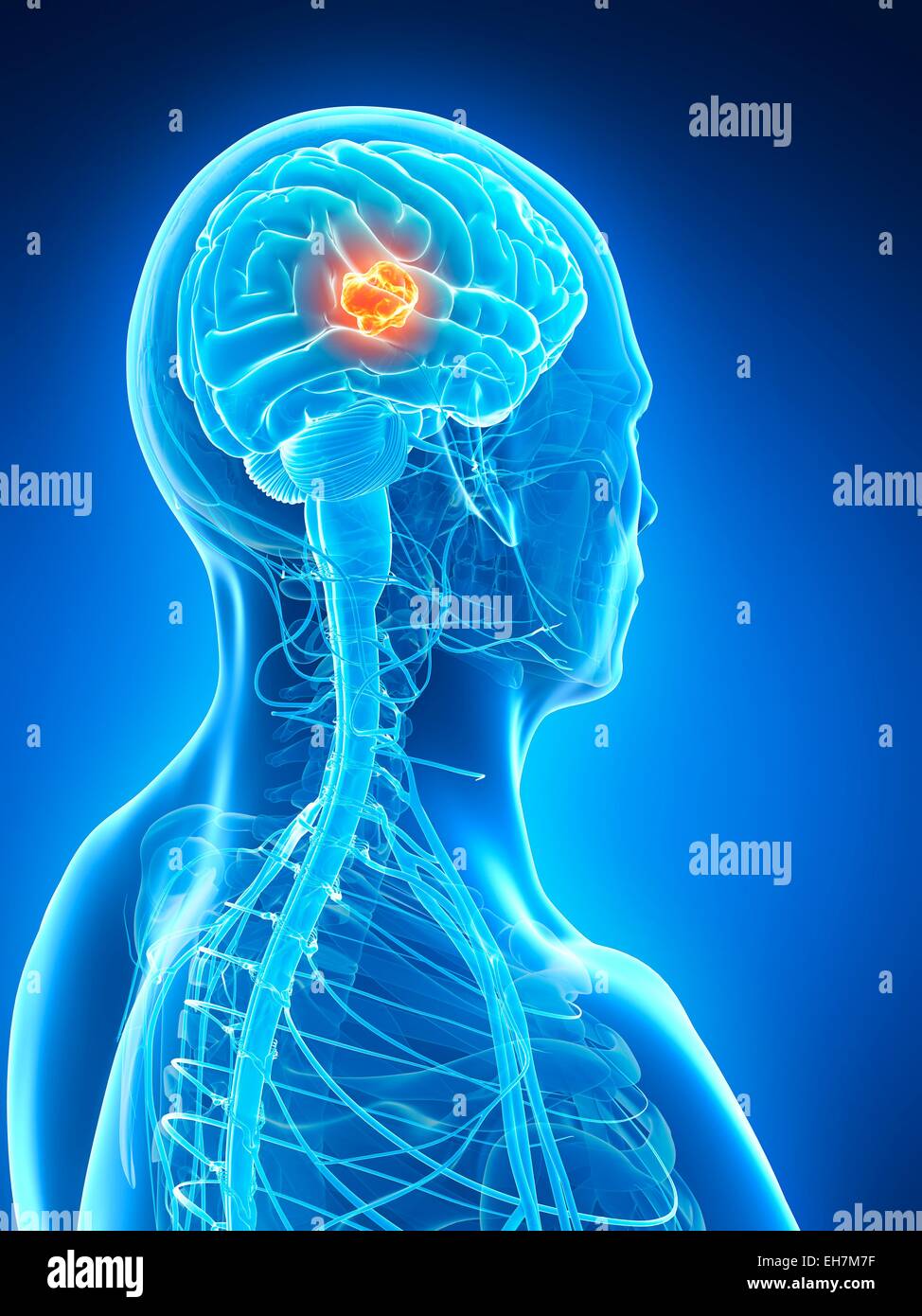 Human brain tumor, illustration Stock Photo - Alamy