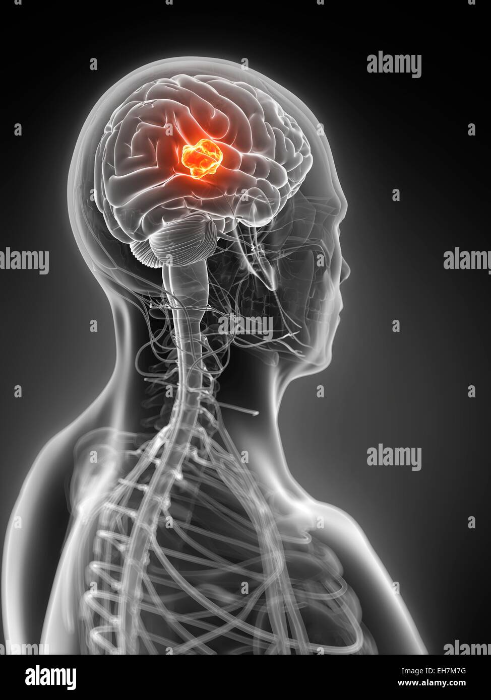 Human brain tumor hi-res stock photography and images - Alamy