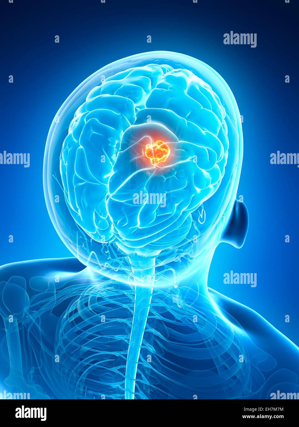 Human brain tumor, illustration Stock Photo - Alamy