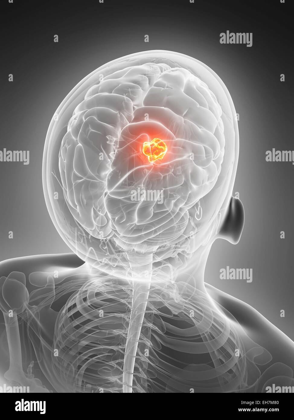 Human brain tumor, illustration Stock Photo - Alamy