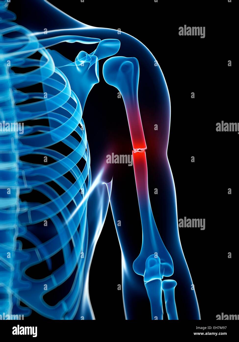 Broken arm bone, illustration Stock Photo - Alamy