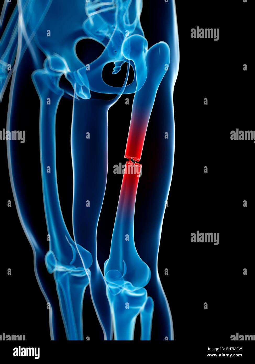 Broken thigh bone hi-res stock photography and images - Alamy