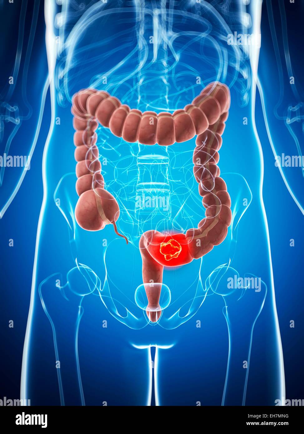Human colon cancer, illustration Stock Photo - Alamy