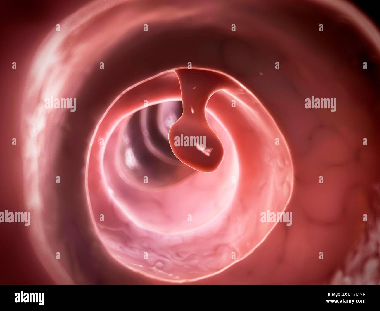 Human colon polyp, illustration Stock Photo - Alamy