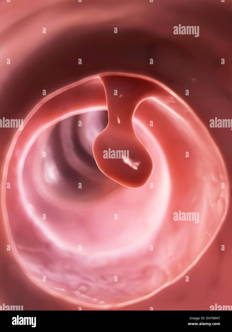 Colon polyp hi-res stock photography and images - Alamy