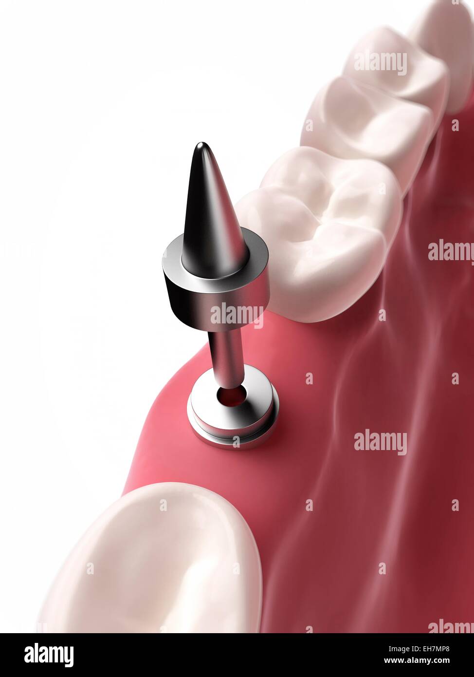 Dental implant illustration hi-res stock photography and images - Alamy